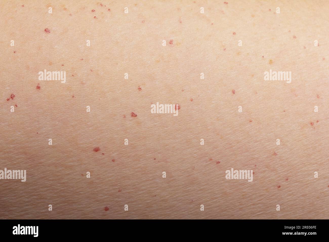 Tumeur d'angiome Banque de photographies et d’images à haute résolution ...