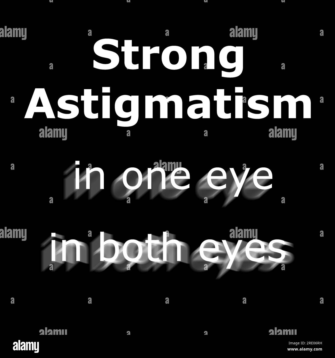 Exemples d'astigmatisme fort dans un œil et dans les deux yeux - avec ...