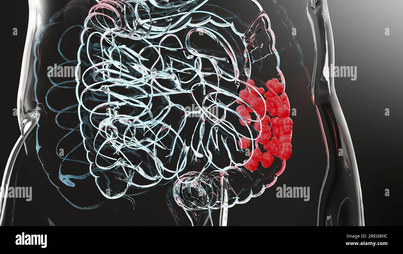 Cancer de l'intestin ou tumeur colorectale, cancer du côlon, maladie ...