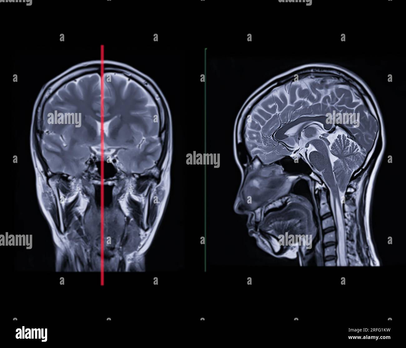 IRM du cerveau Comparer les plans coronaire et sagittal pour détecter ...