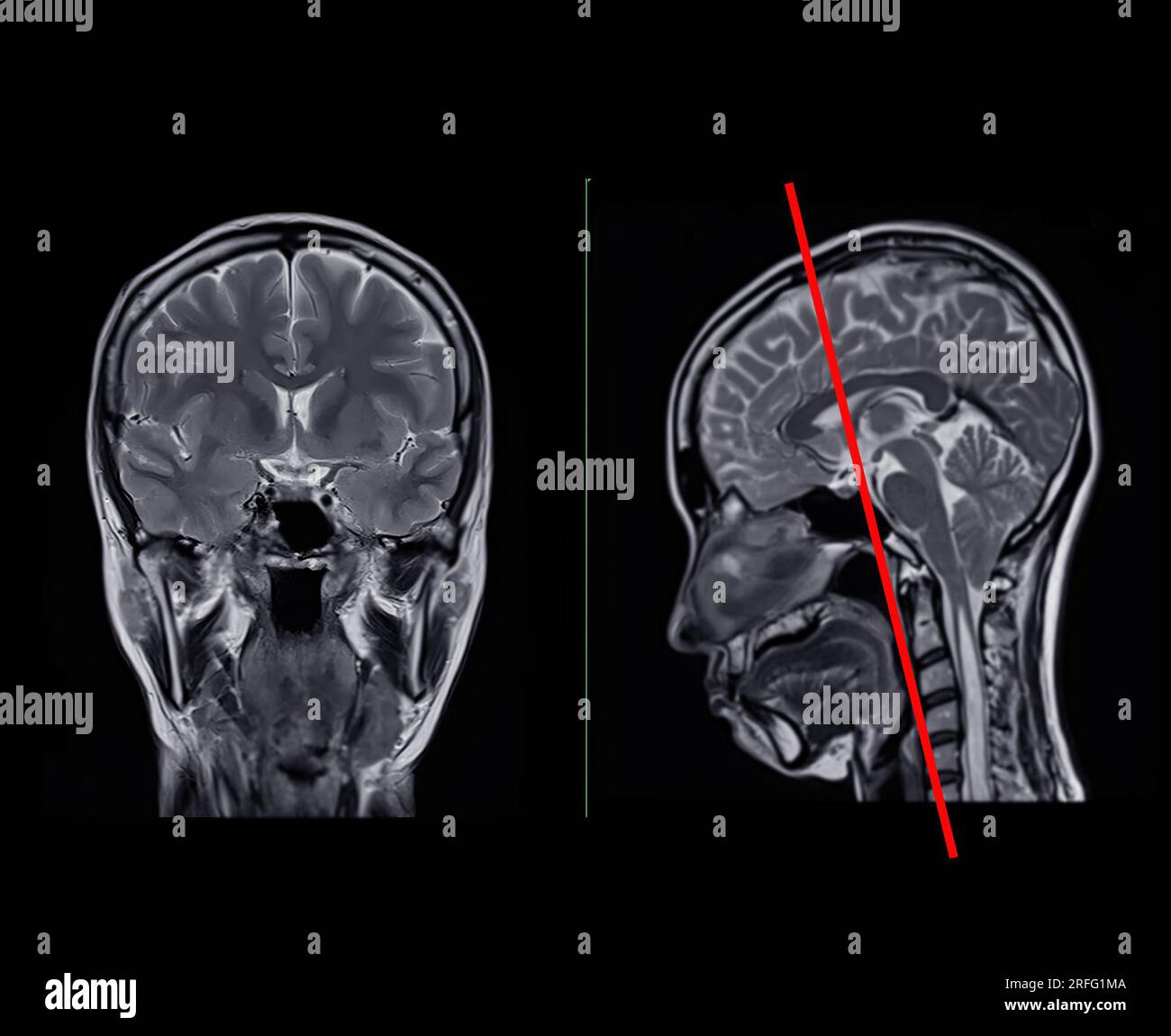 IRM du cerveau Comparer les plans coronaire et sagittal pour détecter ...