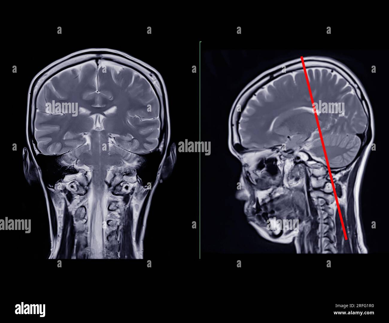 IRM du cerveau Comparer les plans coronaire et sagittal pour détecter ...