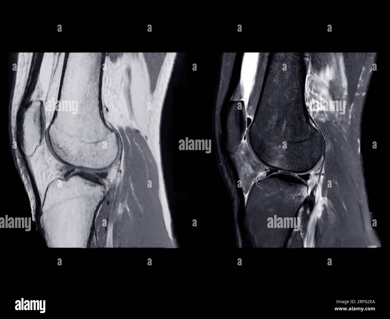 Imagerie par résonance magnétique ou IRM de l'articulation du genou ...