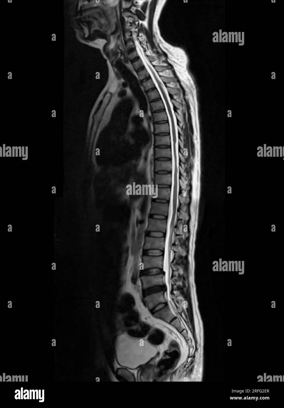 IRM du plan sagittal T2W de la colonne vertébrale entière pour la ...