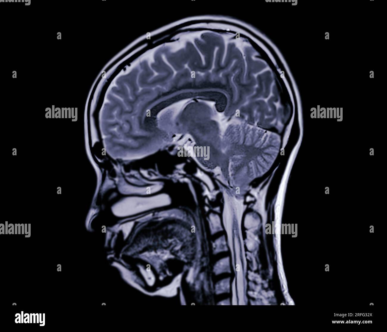 Plan sagittal de balayage de cerveau d'IRM pour détecter les maladies du cerveau comme les ...