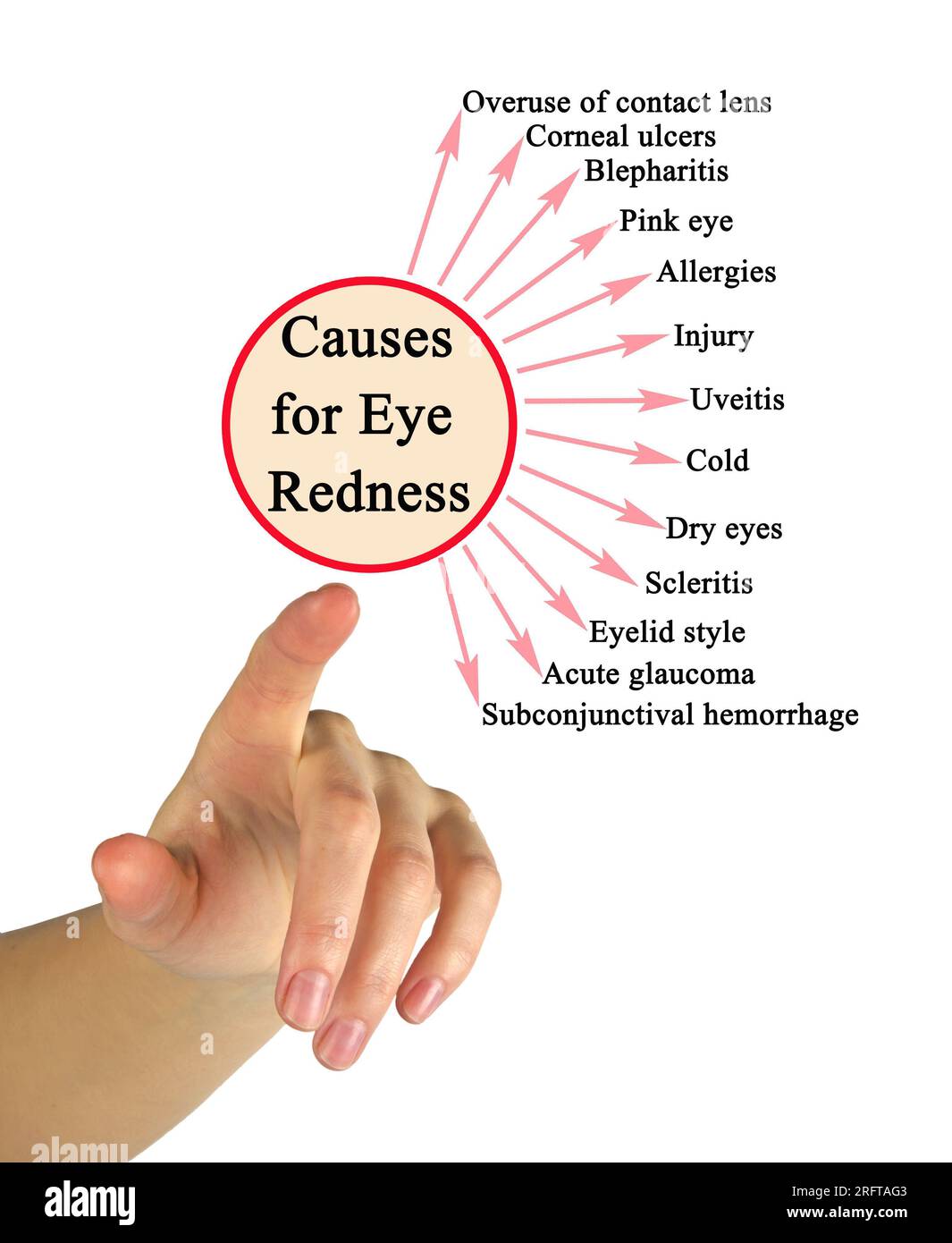 Rougeur oculaire Banque de photographies et d’images à haute résolution ...