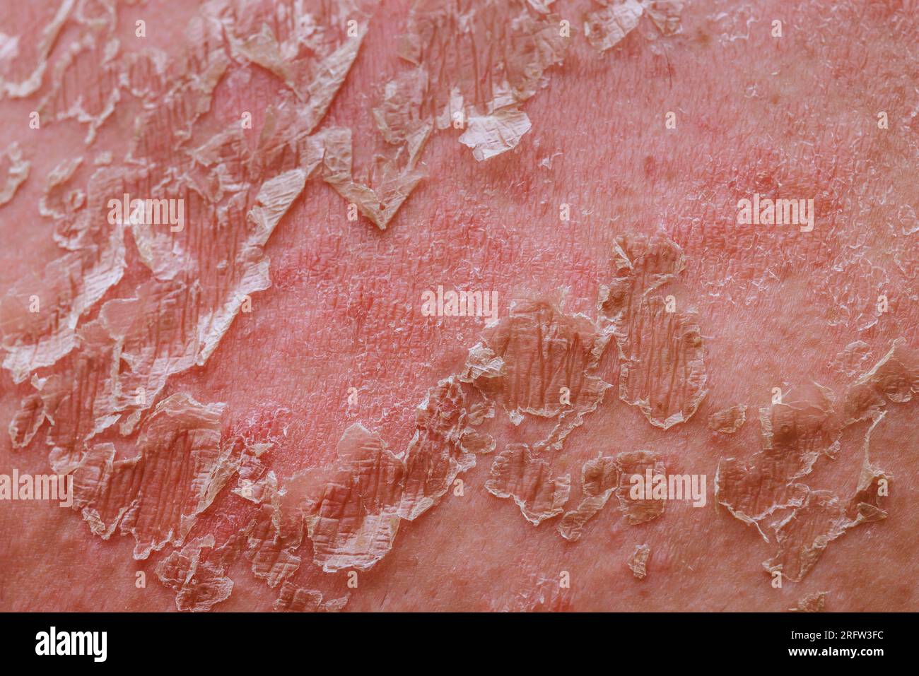 Le corps humain développe une peau rougie irritée avec des écailles ...