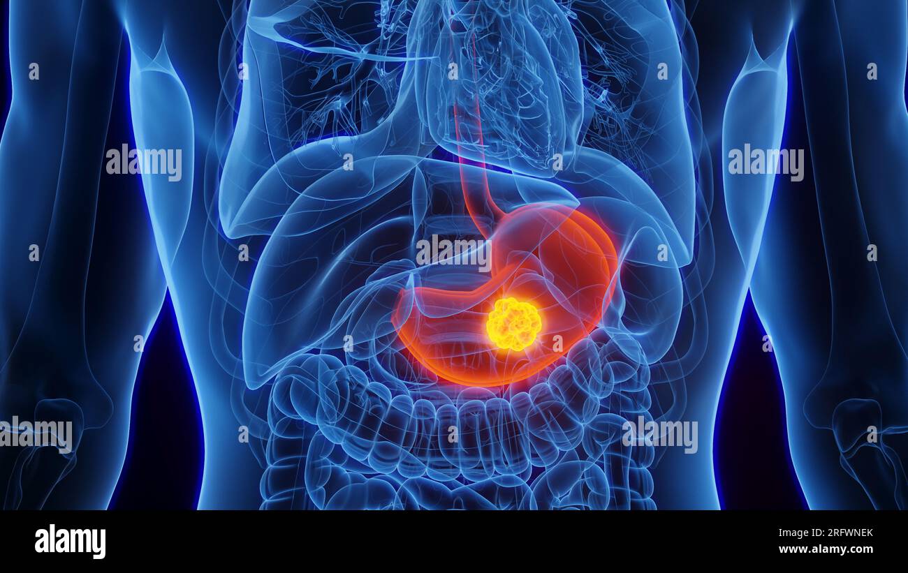 Cancer du cardia Banque de photographies et d’images à haute résolution ...