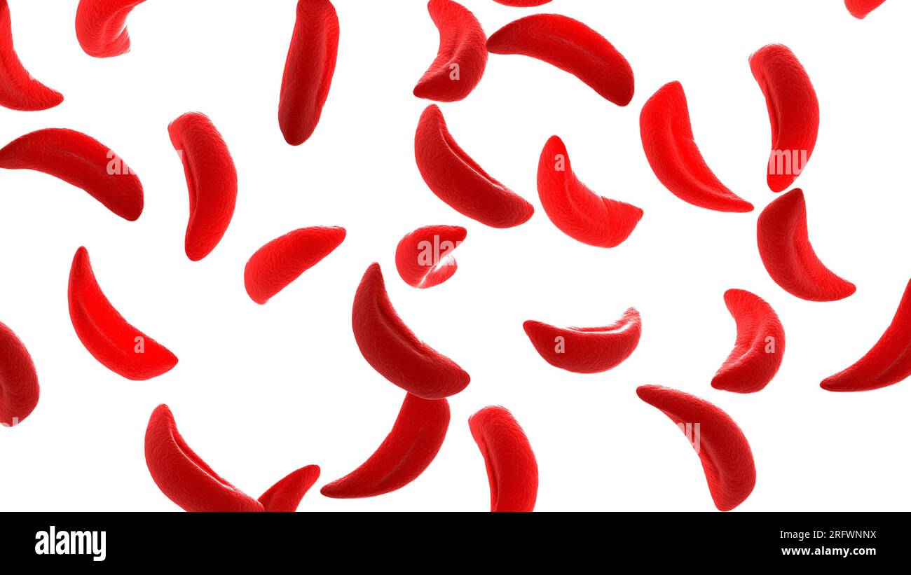 Sickle cell disease Banque de photographies et d’images à haute ...