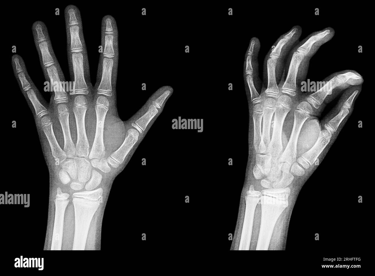 Radiographie des mains, détail des phalanges et des articulations ...