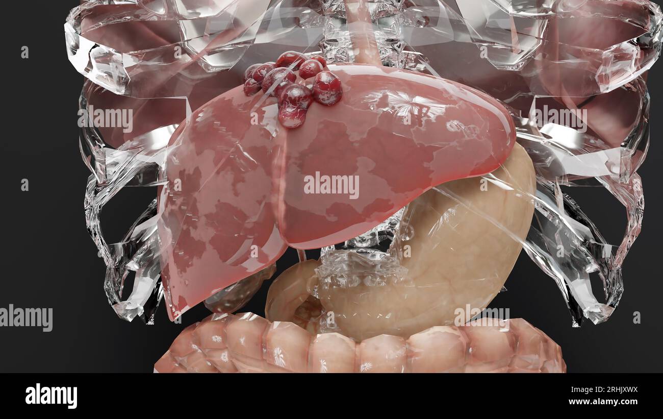 La maladie du foie gras humain Banque de photographies et d’images à ...