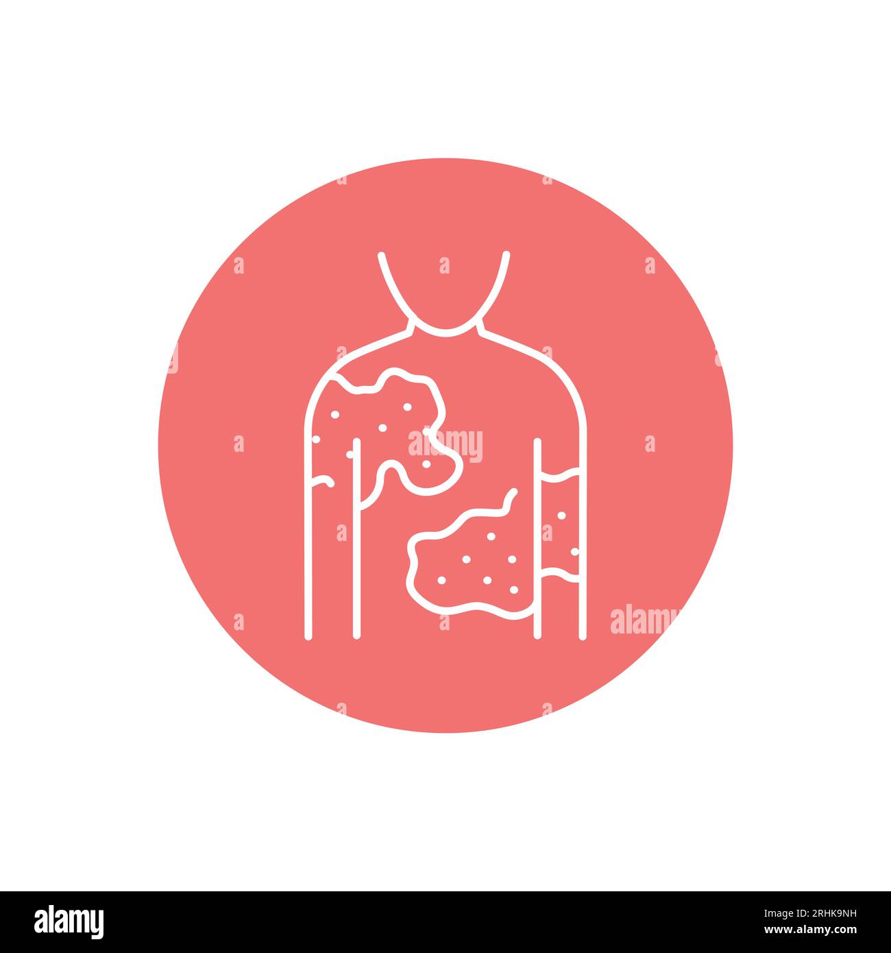 Urticaire chronique Banque de photographies et d’images à haute ...