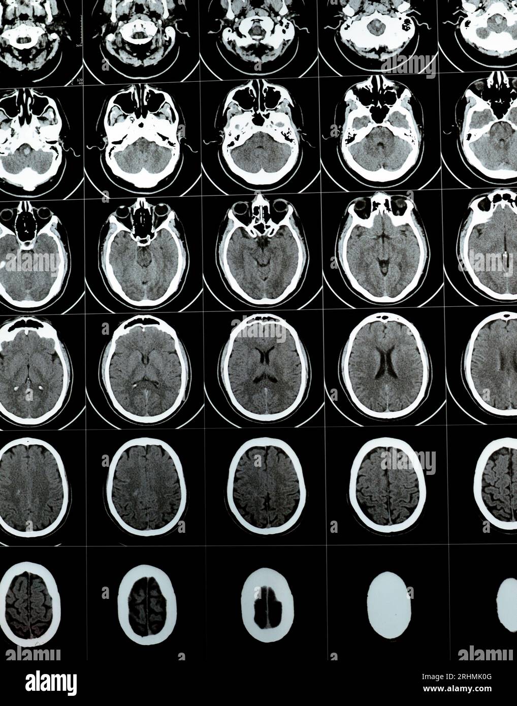 Irm normal du cerveau Banque de photographies et d’images à haute ...