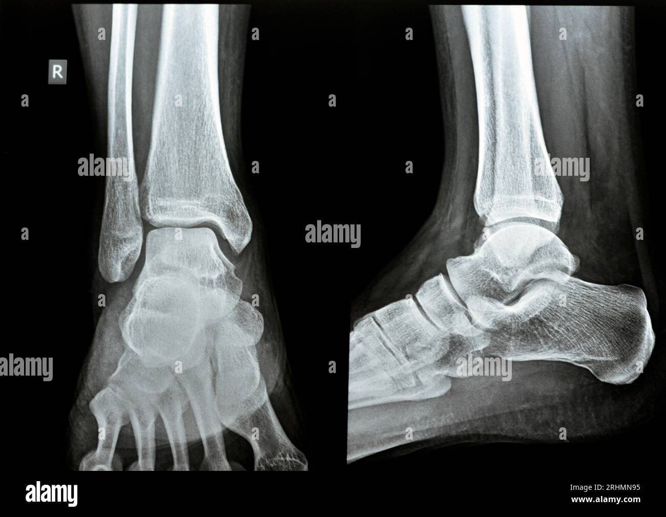 Radiographie directe AP vues latérales de la cheville droite montrant ...