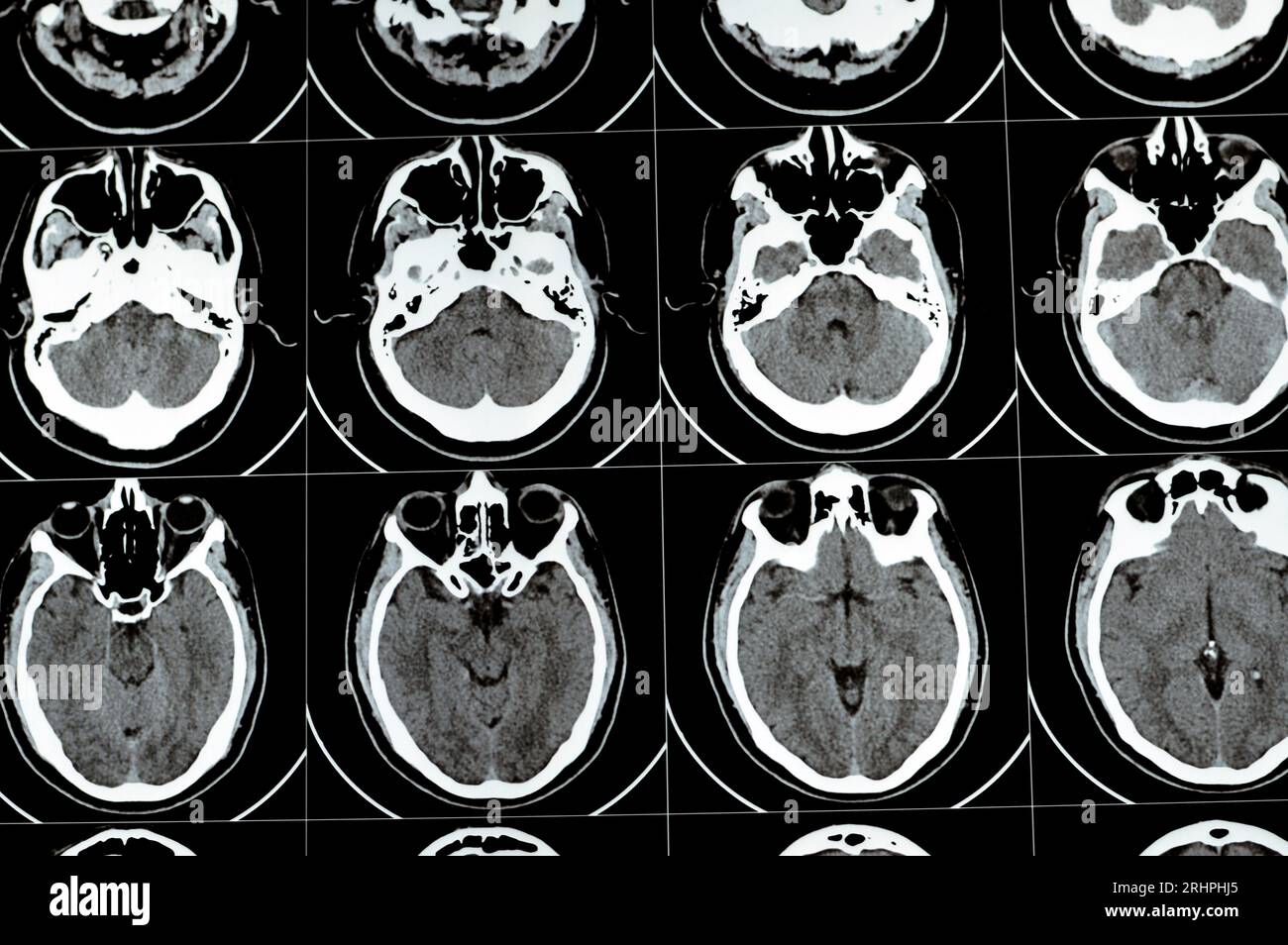 Irm anormal du cerveau Banque de photographies et d’images à haute résolution - Alamy