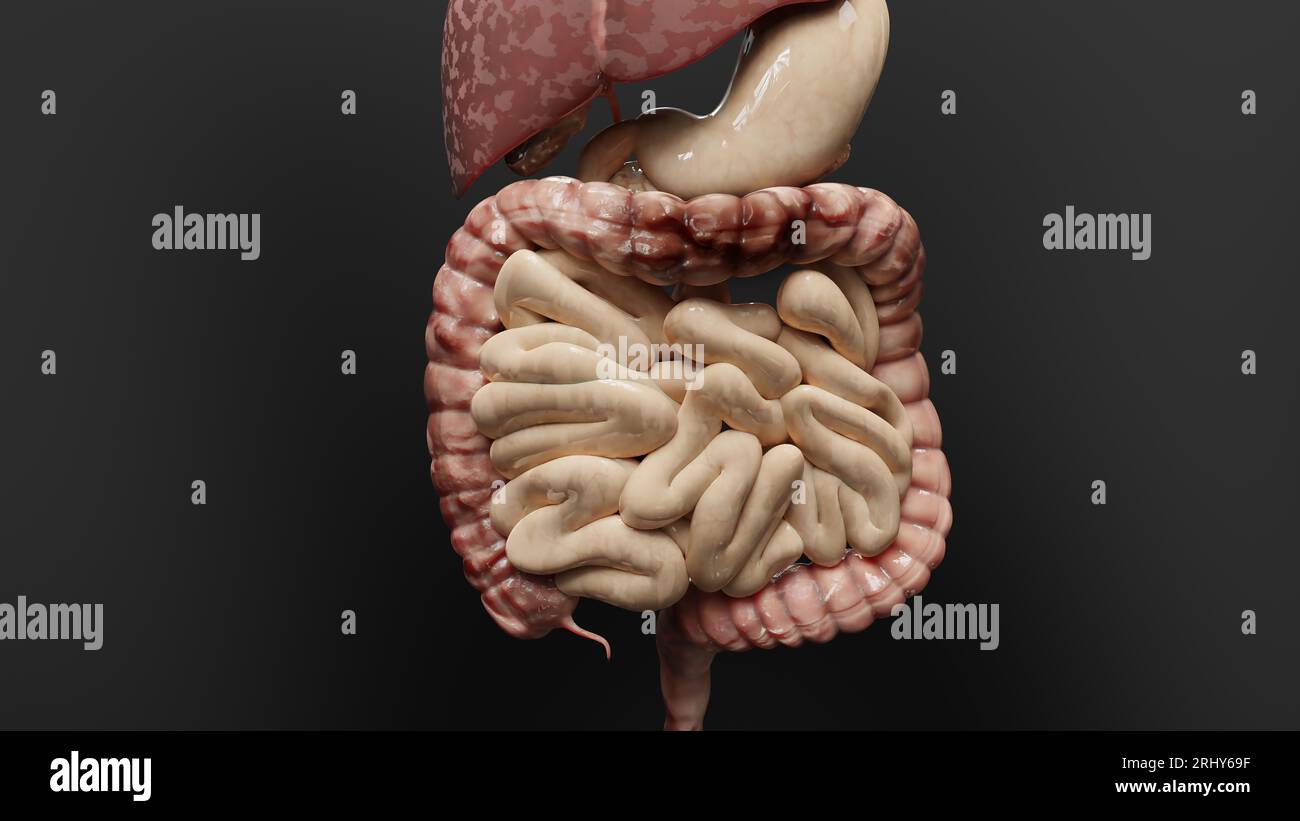 Cancer de l'intestin ou tumeur colorectale, cancer du côlon, maladie ...