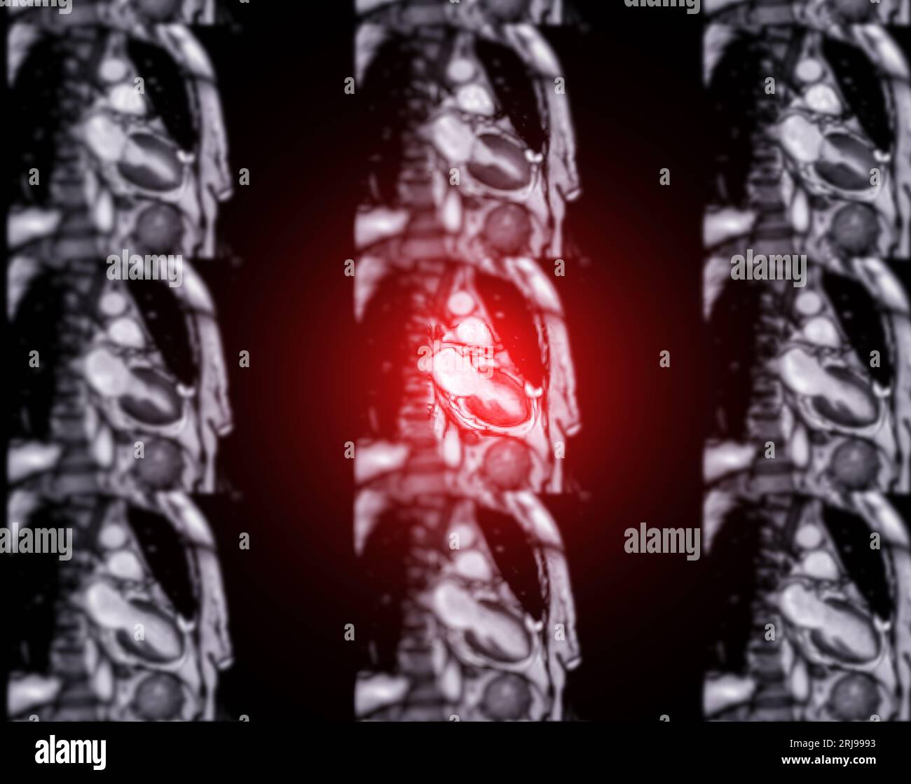 IRM cardiaque ou IRM cardiaque ( imagerie par résonance magnétique ) du ...