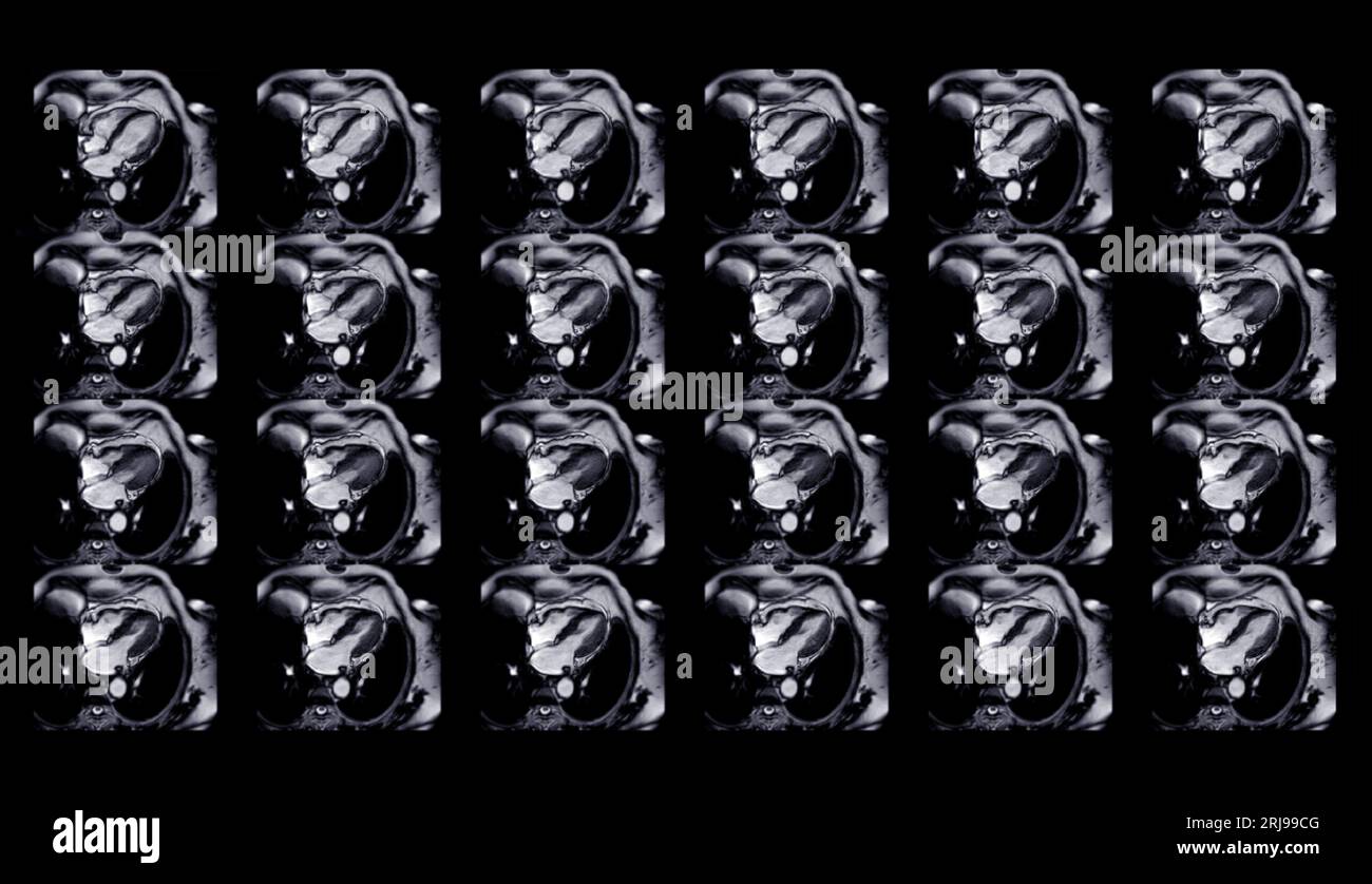 IRM cardiaque ou IRM cardiaque ( imagerie par résonance magnétique ) du ...