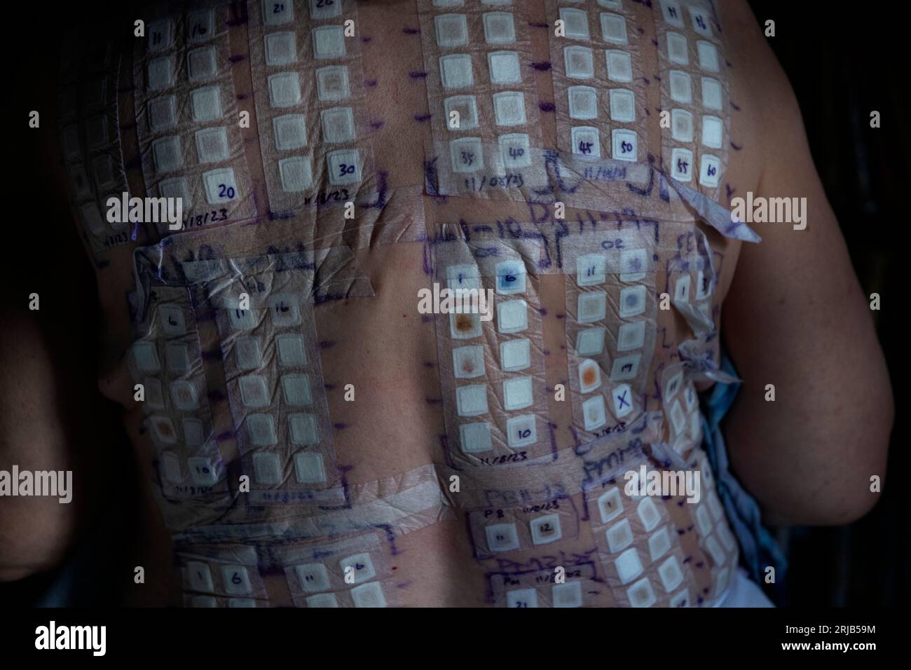 Test de patch d'allergie Angleterre modèle de photographie releaed août ...