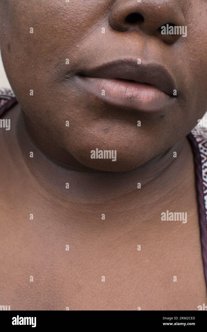 Taches noires peau Banque de photographies et d’images à haute ...