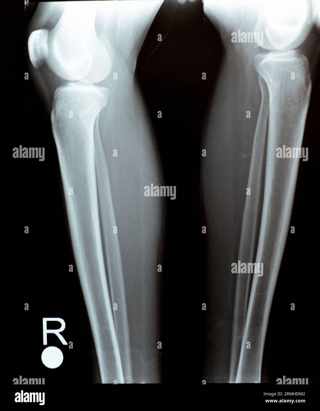 Genou normal Banque de photographies et d’images à haute résolution - Alamy