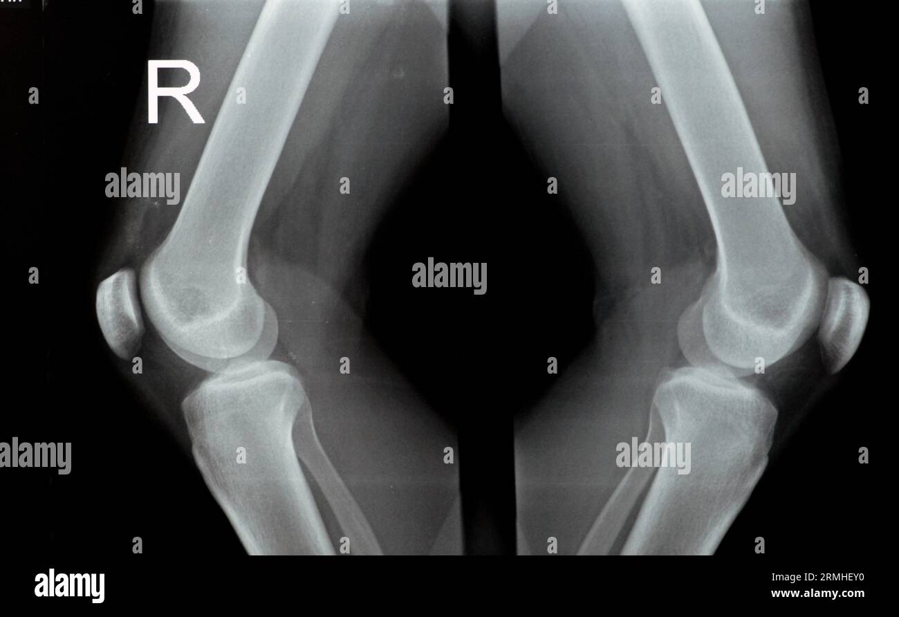 Radiographie simple des articulations droite et gauche du genou avec ...