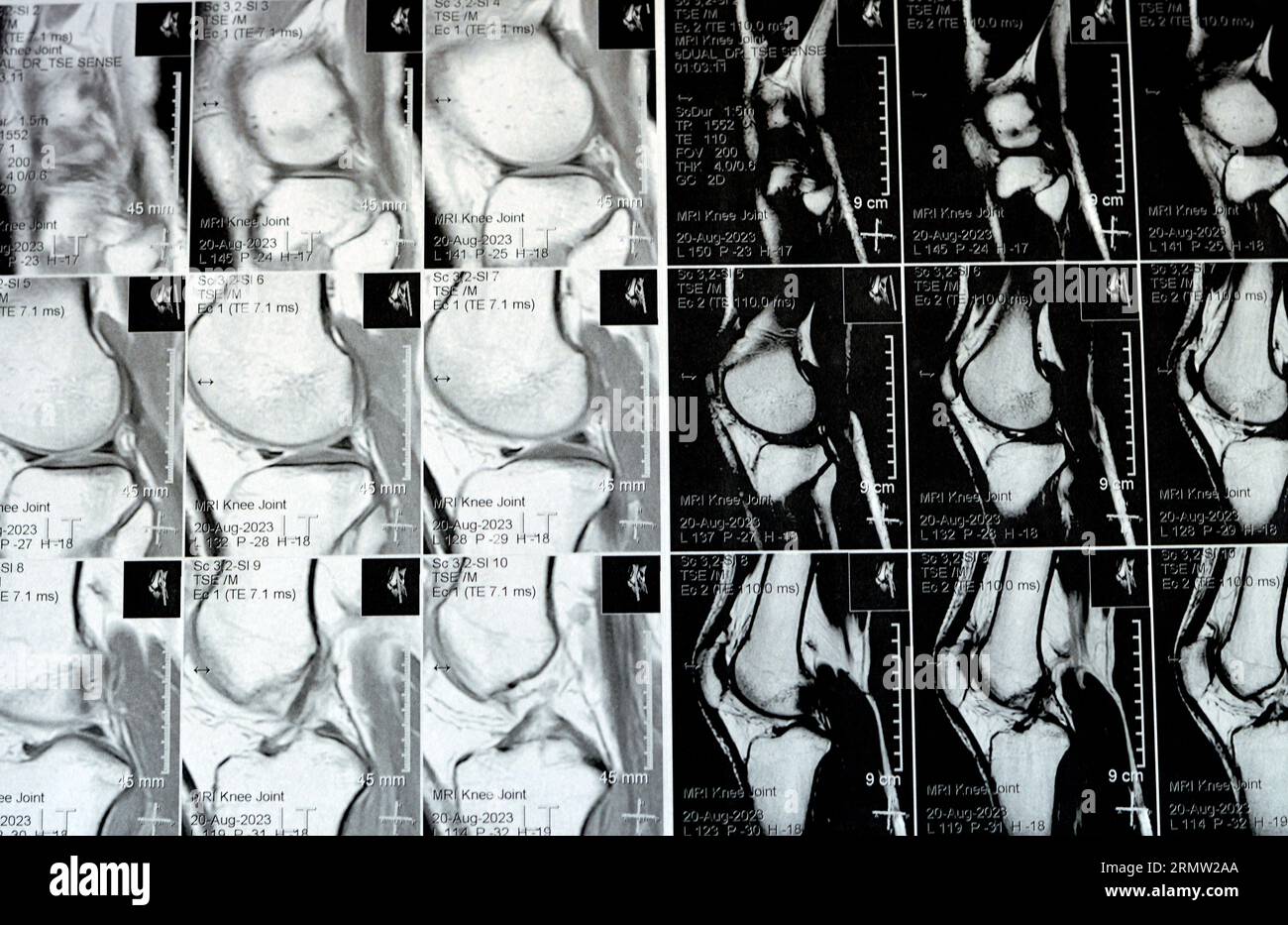IRM du genou droit montrant un léger épanchement articulaire, avec d ...