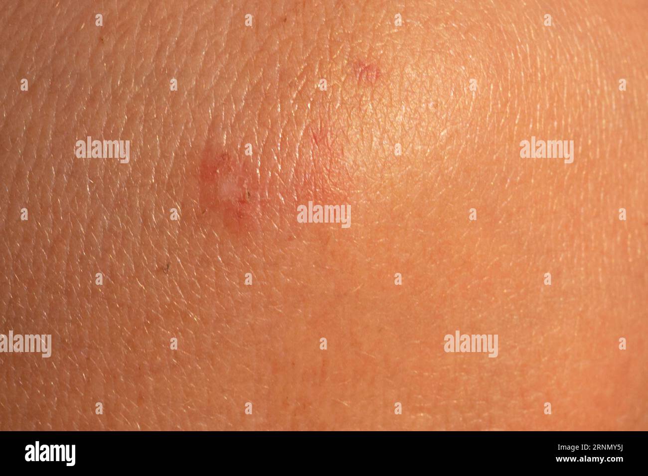 Examen dermatologique Banque de photographies et d’images à haute ...