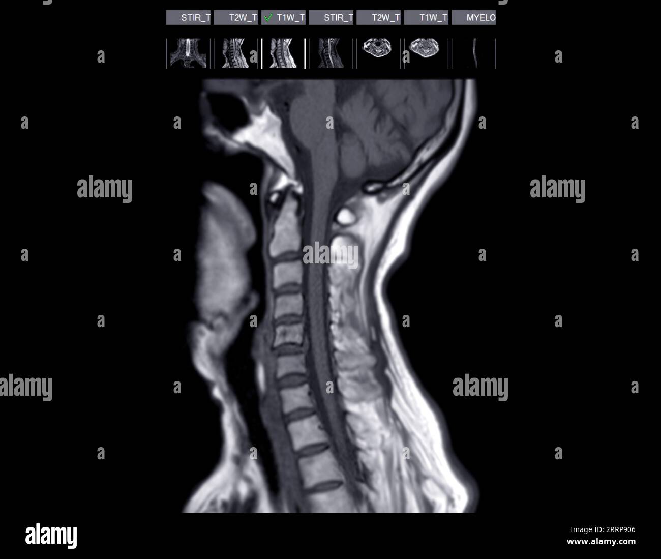 IRM du rachis cervical ou imagerie par résonance magnétique du rachis ...