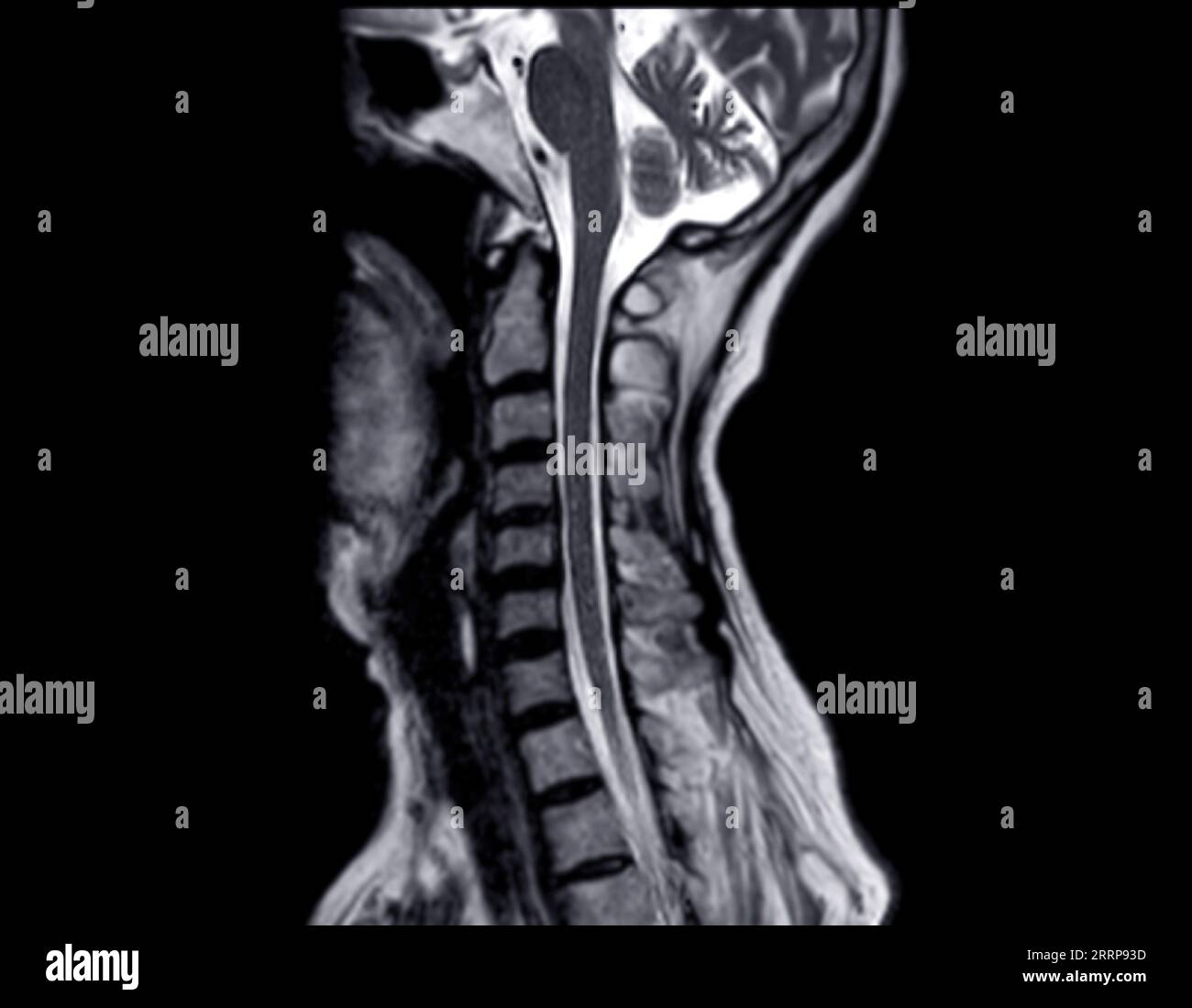 IRM du rachis cervical ou imagerie par résonance magnétique du rachis ...