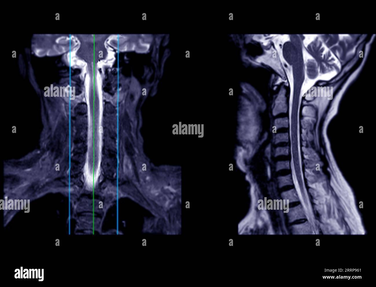 IRM du rachis cervical ou imagerie par résonance magnétique du rachis ...