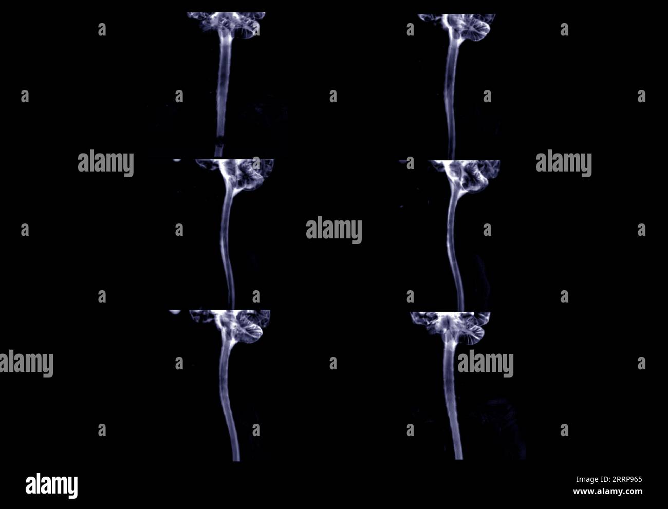 IRM du rachis cervical ou imagerie par résonance magnétique du rachis ...