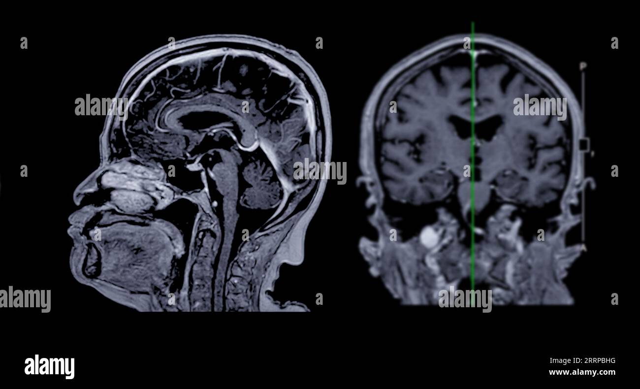 IRM du cerveau vue sagittale et coronale avec ligne de référence pour détecter les maladies ...