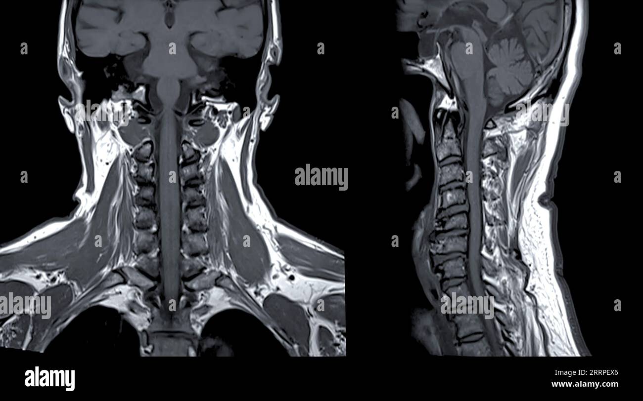 IRM du rachis cervical ou imagerie par résonance magnétique du rachis ...