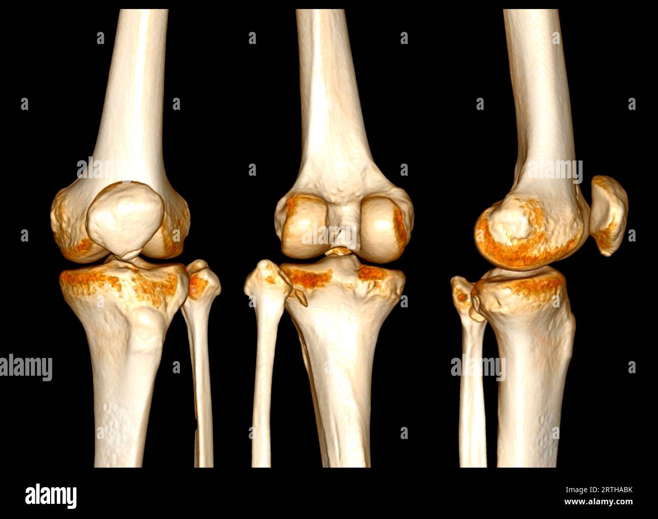 Fracture de la rotule Banque de photographies et d’images à haute ...