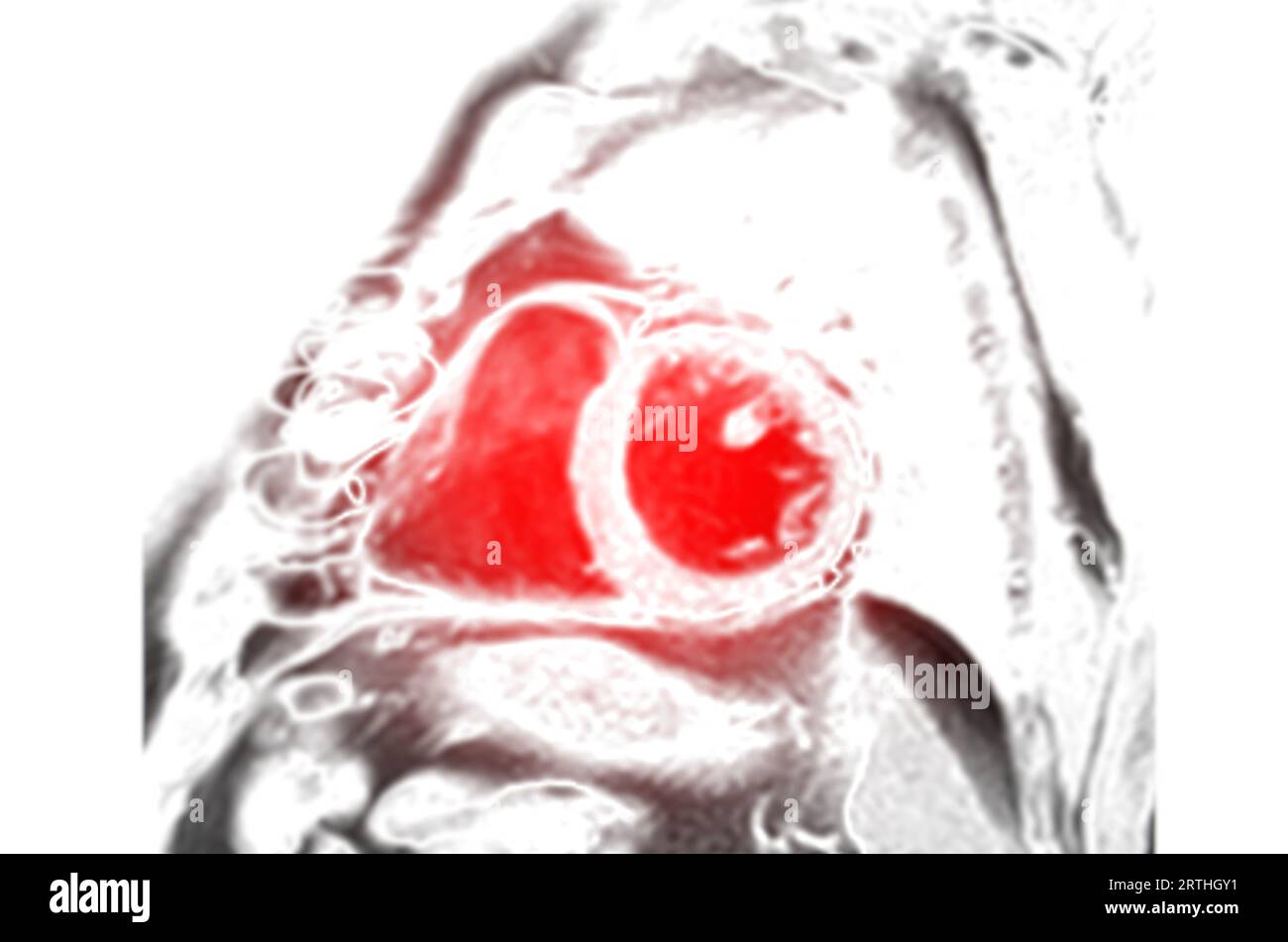 IRM cardiaque ou IRM cardiaque ( imagerie par résonance magnétique ) de ...