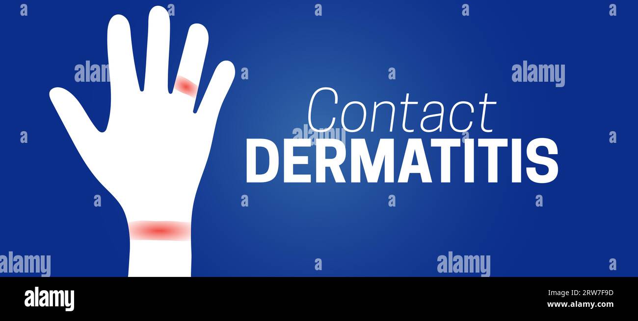 Dermatite de contact Banque de photographies et d’images à haute ...