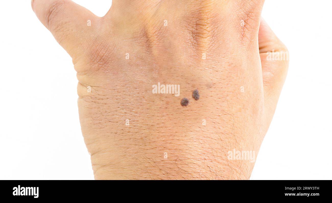 main masculine, sèche et avec taches cutanées, problème dermatologique ...