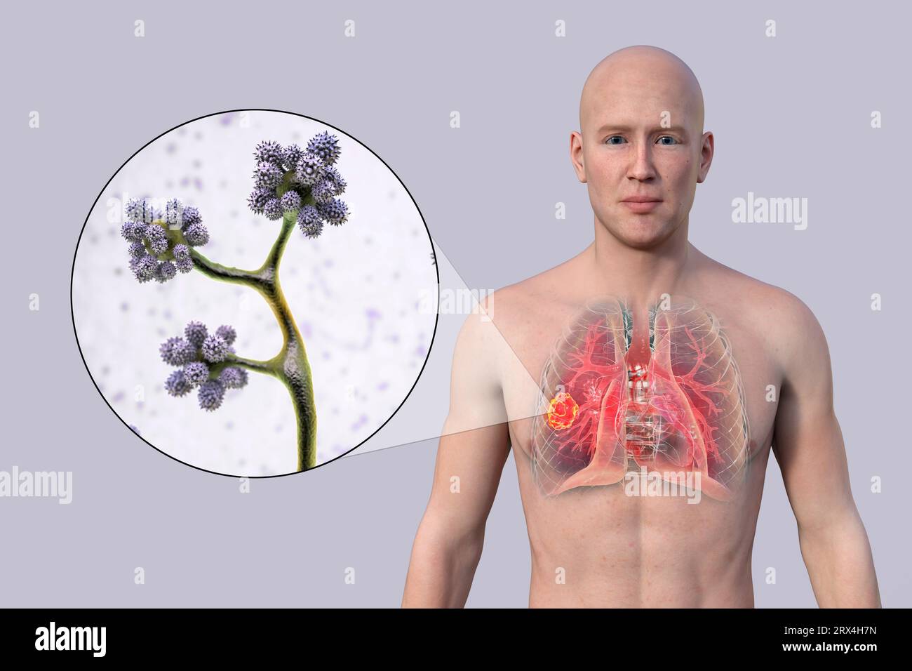 Mucormycose pulmonaire Banque de photographies et d’images à haute résolution - Alamy