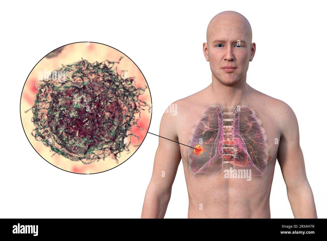 Cancer du poumon organes pulmonaires Banque de photographies et d’images à haute résolution ...