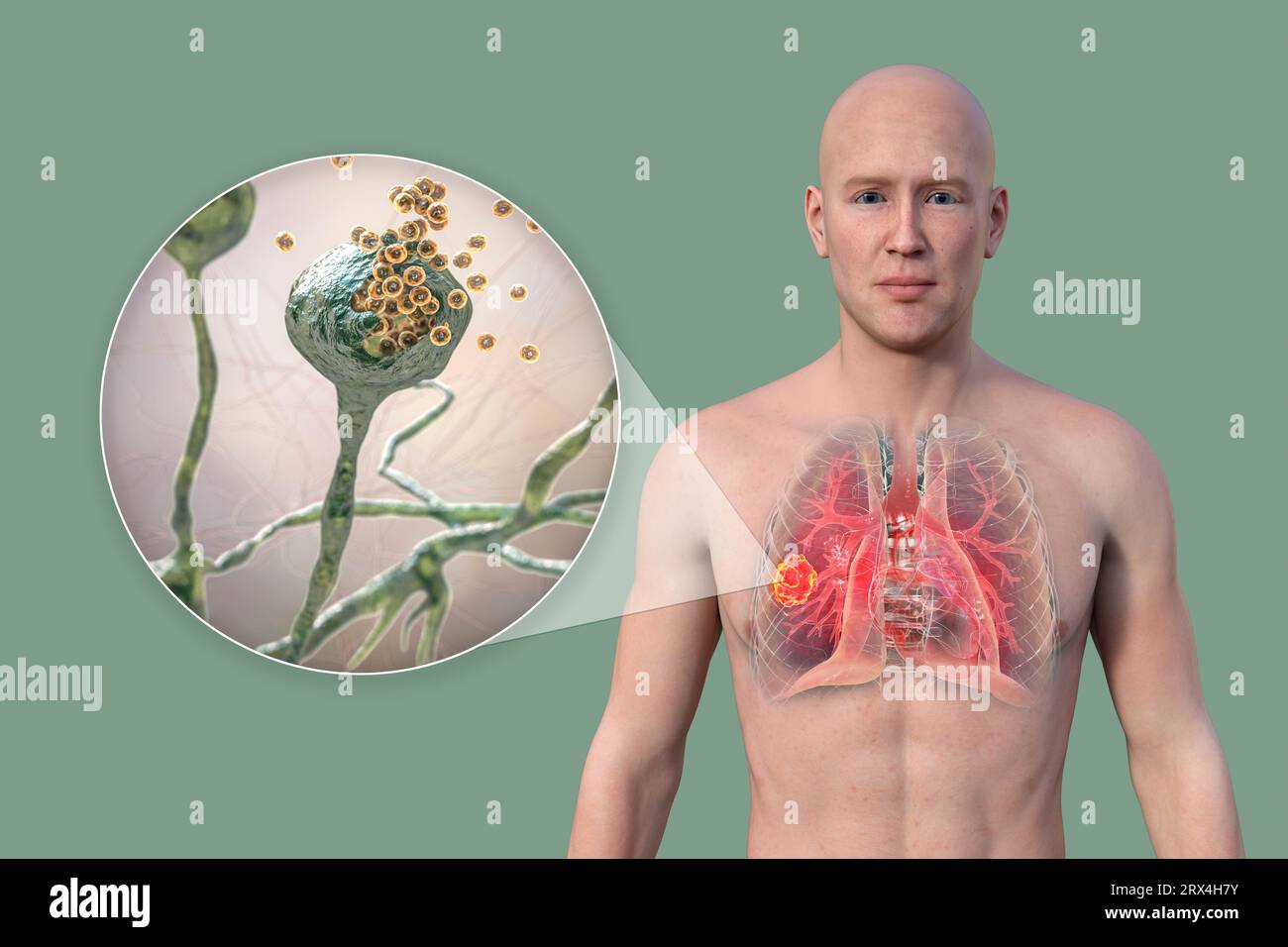 Mucormycose pulmonaire Banque de photographies et d’images à haute résolution - Alamy