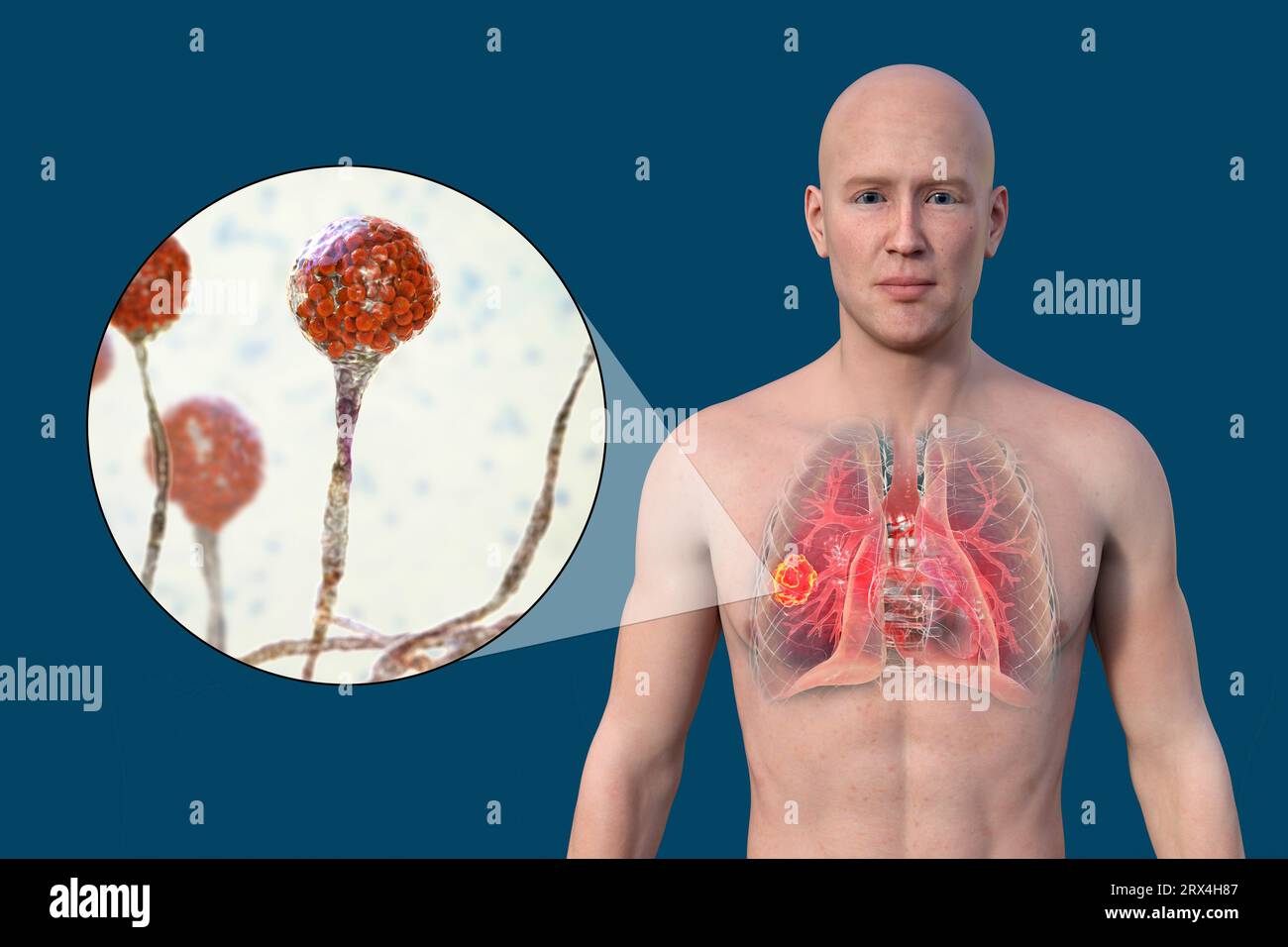 Mucormycose pulmonaire Banque de photographies et d’images à haute résolution - Alamy