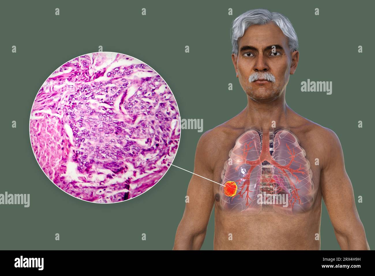 Histopathologie de cancer du poumon Banque de photographies et d’images ...