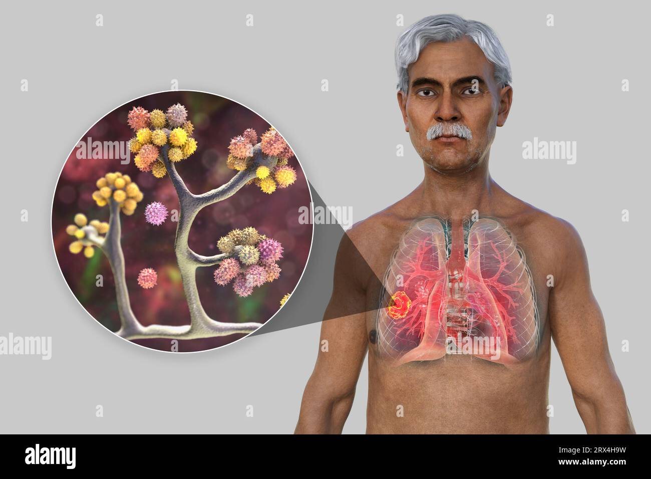 Mucormycose pulmonaire Banque de photographies et d’images à haute résolution - Alamy