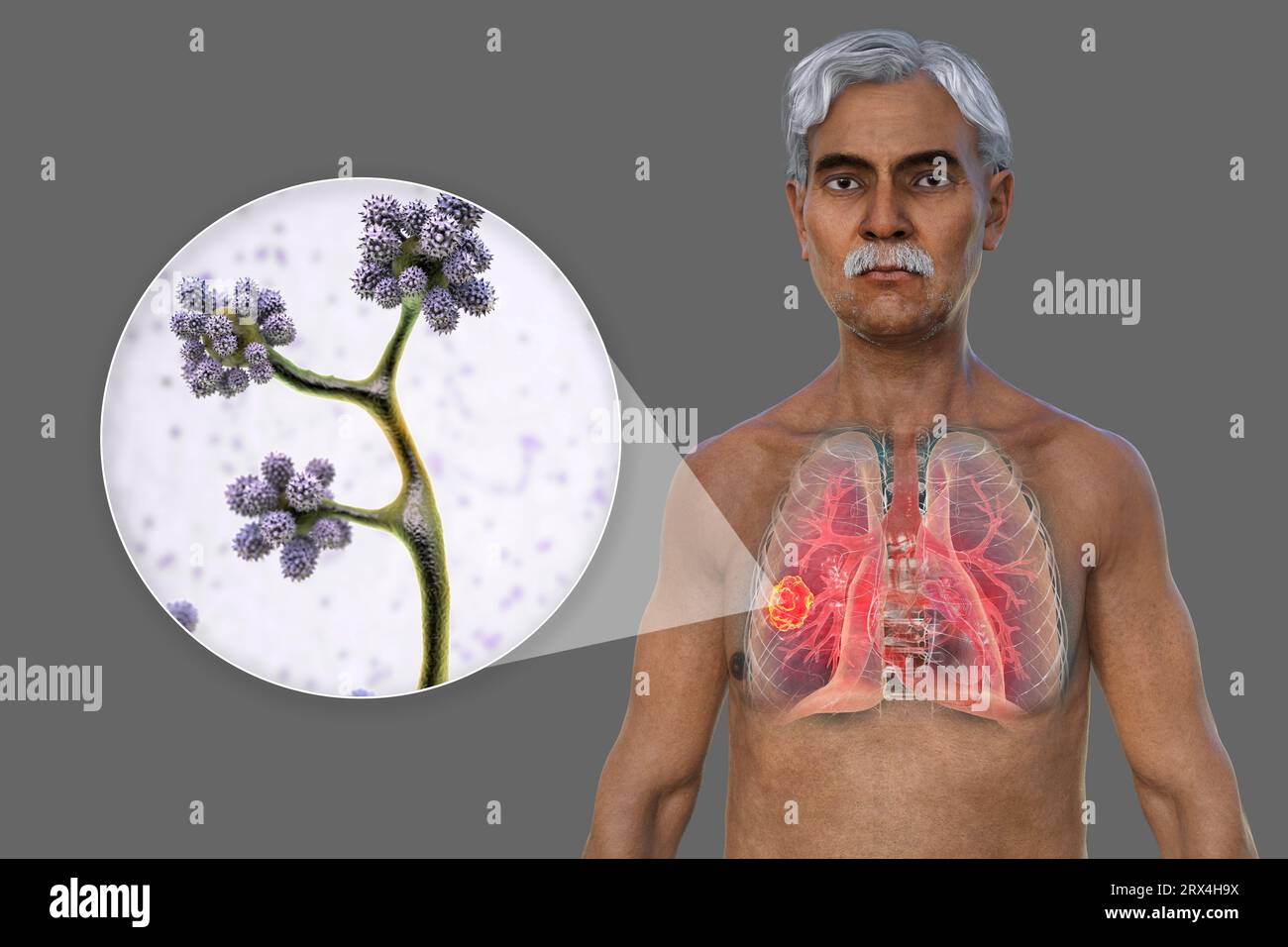 Mucormycose pulmonaire Banque de photographies et d’images à haute résolution - Alamy