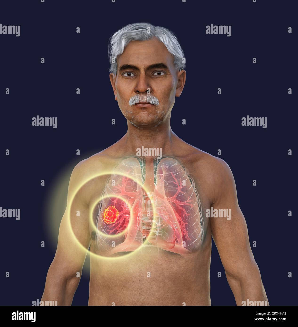 Mucormycose pulmonaire Banque de photographies et d’images à haute résolution - Alamy