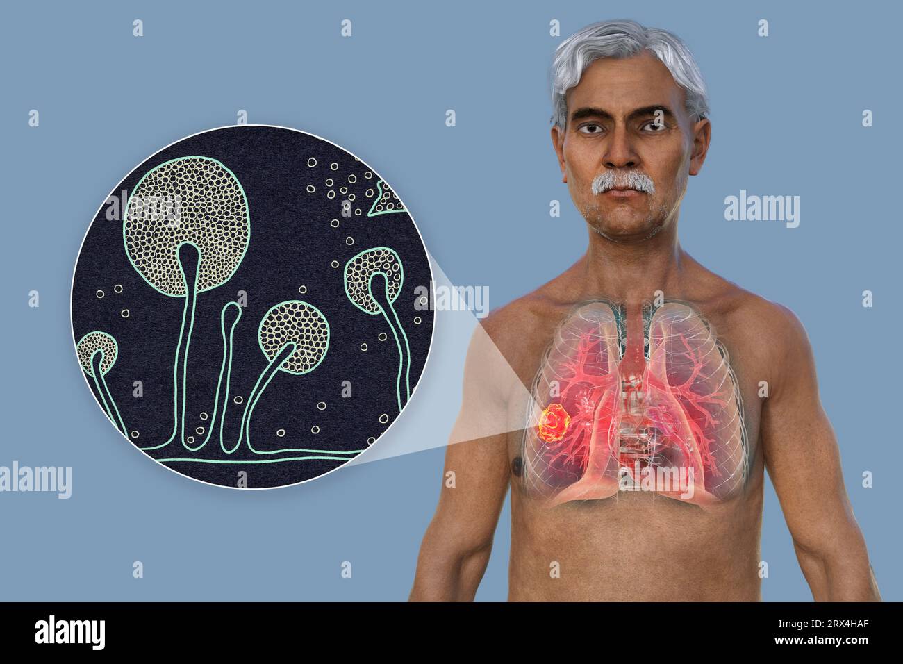 Mucormycose pulmonaire Banque de photographies et d’images à haute résolution - Alamy