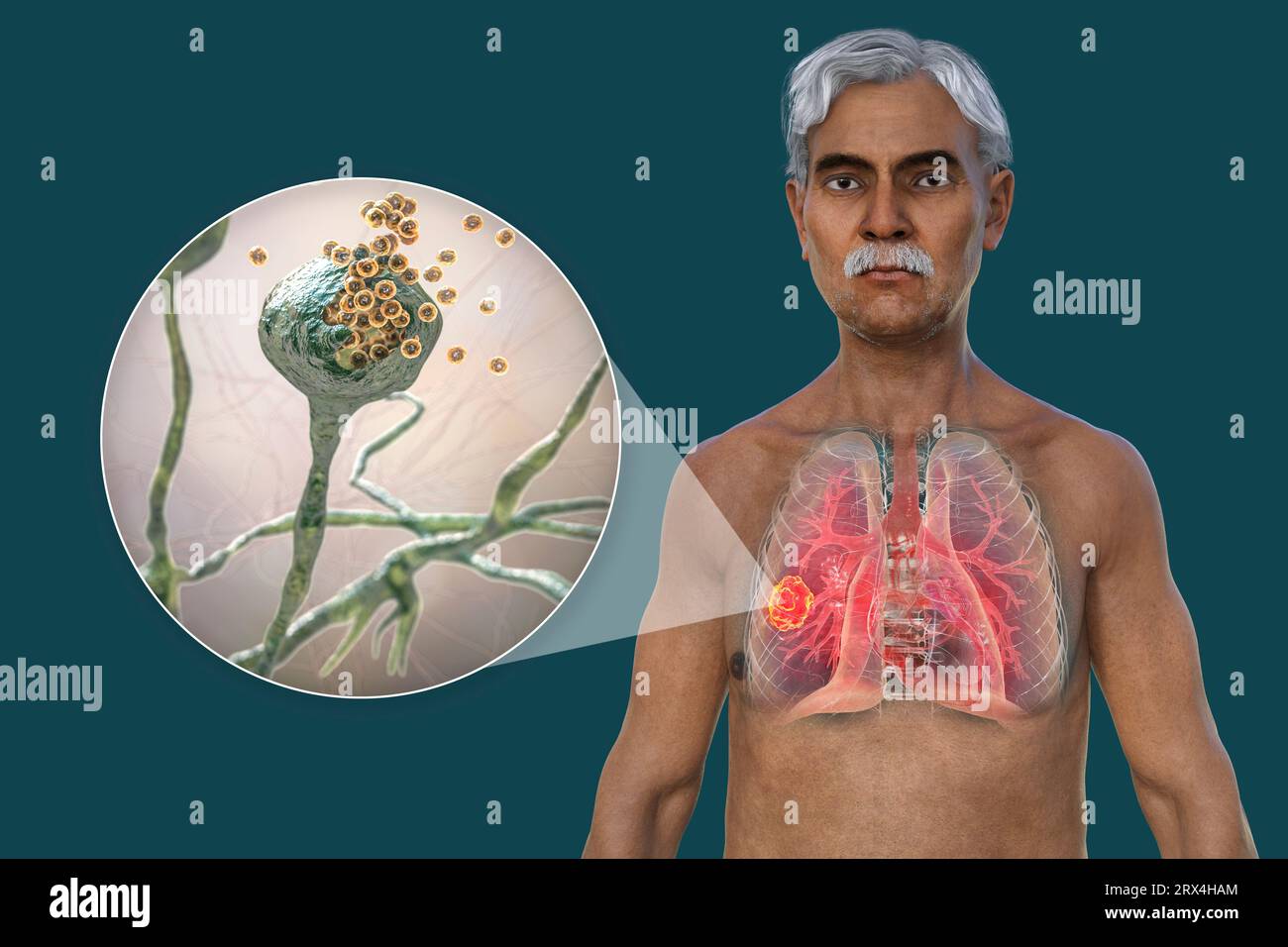 Mucormycose pulmonaire Banque de photographies et d’images à haute résolution - Alamy