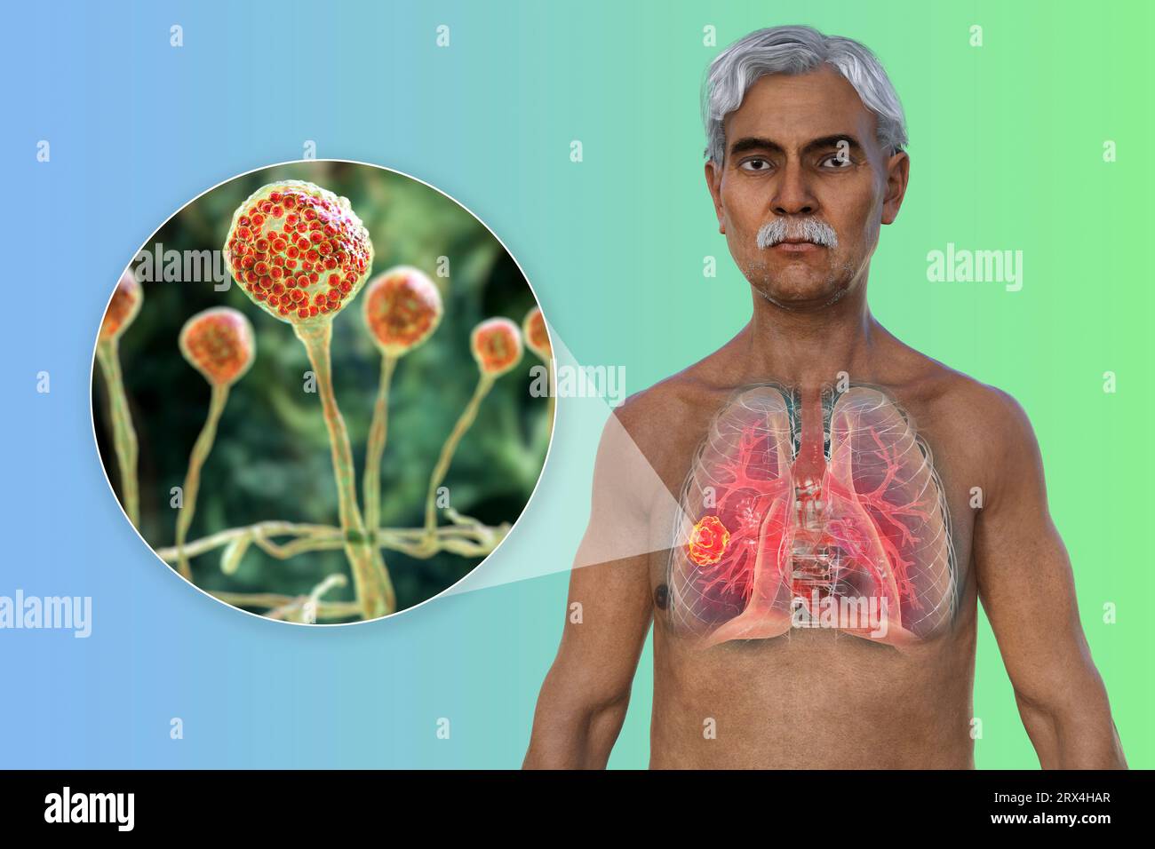 Mucormycose pulmonaire Banque de photographies et d’images à haute résolution - Alamy