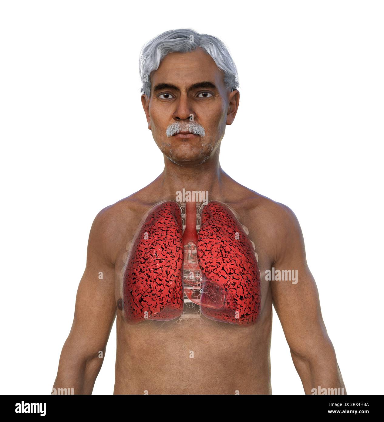 Poumon fumeur Banque de photographies et d’images à haute résolution ...